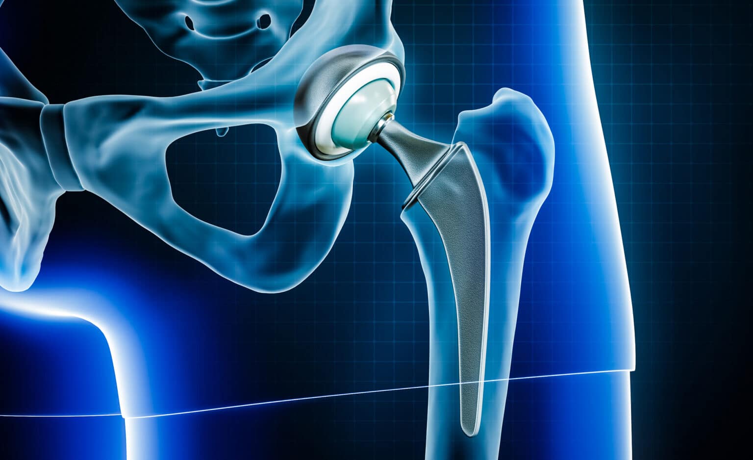 Direct Anterior Hip Replacement - Dr. William F. Tucker, Jr.